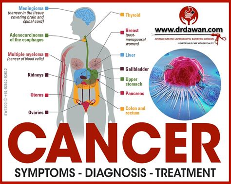 Adenocarcinoma Cancers Symptoms Causes Diagnosis