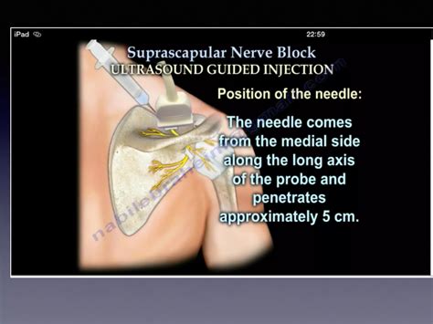 Shoulder Block Tutorial 2014 Ppt