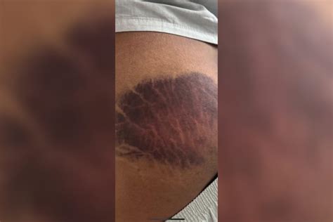 Curso Da Pmdf Soldado Agredido Teve Lesão Renal E Visão Prejudicada