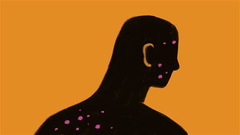 Acne Symptoms Causes And Treatments Page 5 Self