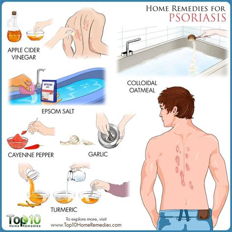 Psoriasis Home Remedies For Relief And When To See A Doctor Top 10