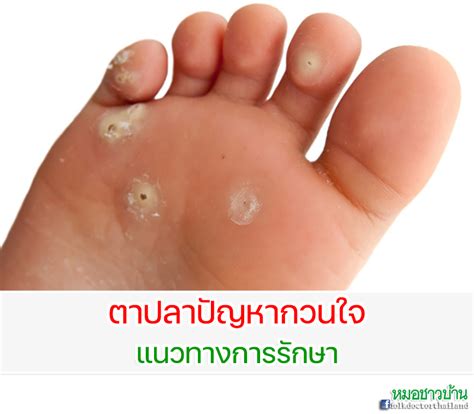 Empower Living ตาปลาปัญหากวนใจ