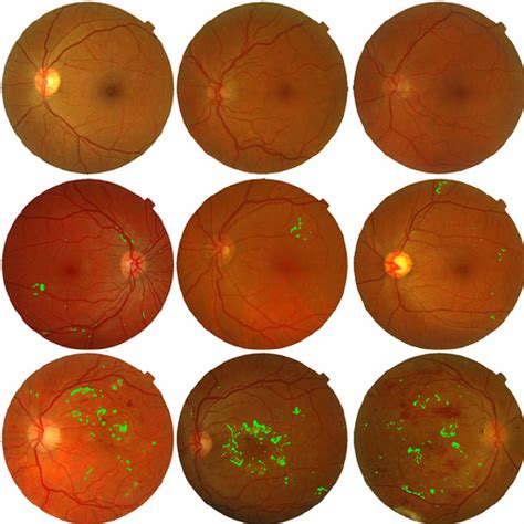 Maculopathy Detection First Row Healthy Retinal Images Second Row Download Scientific