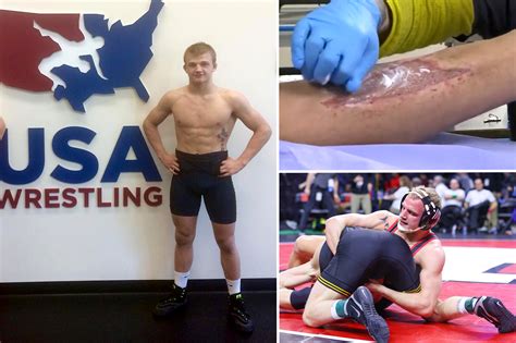 Flesh Eating Bacteria Sidelines College Wrestler