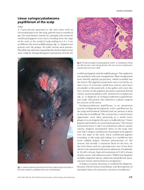 Pdf Linear Syringocystadenoma Papilliferum Of The Scalp Devinder Pdf Linear Syringocystadenoma Papilliferum Of The Scalp Devinder