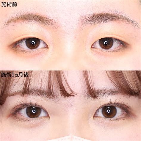 【埋没法】ナチュラル可愛い目元へ｜症例写真・ビフォーアフター｜美容整形･美容外科のtaクリニックグループ