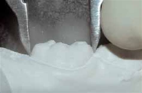 Mesiodistal Size The Distance Between The Mesial And Distal Points Of