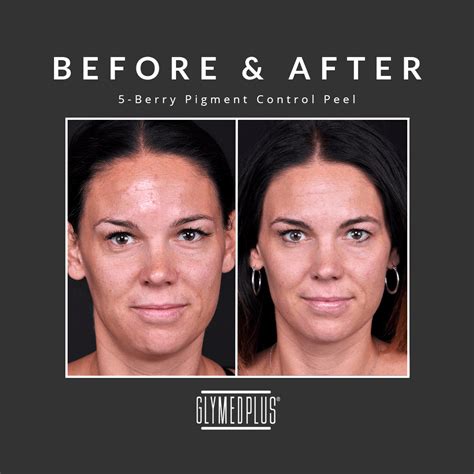 Chemical Peels In Naples Fl Kim Gallo Esthetics
