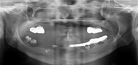 Panoramic Image Showing Rootless Teeth In Case Of Dentin Dysplasia
