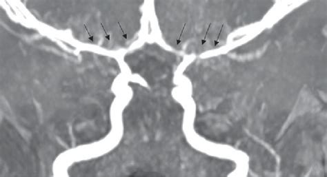 Mra Anterior Circulation Mra Demonstrates Bilateral Supraclinoid