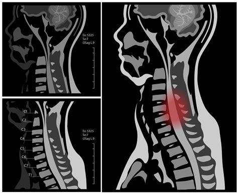 resonancia magnética de la columna cervical con y sin contraste