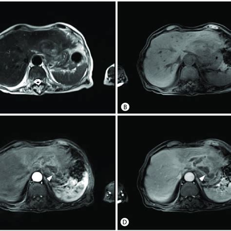 Magnetic Resonance Imaging Of The Liver Showed A Multiseptated Lesion