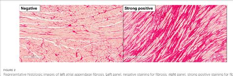 Figure 1 From Left Atrial Strain Predicts Fibrosis Of Left Atrial Appendage In Patients With