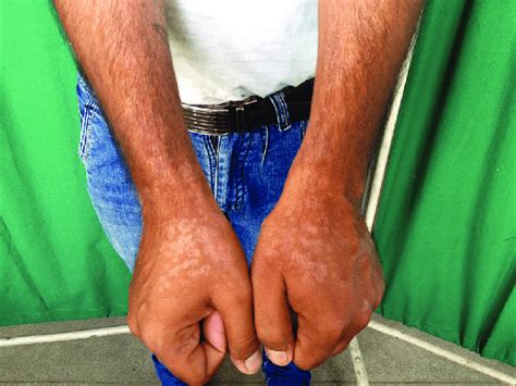 Depigmented To Hypopigmented Macules And Patches Of Size Ranging From Download Scientific