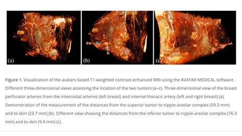 Enhancing Surgical Planning For Breast Cancer Reconstruction Using Virtual Reality