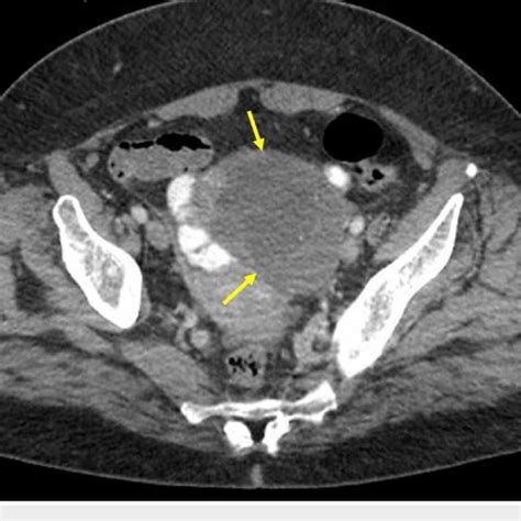Pelvic Ct Showing Semi Solidsemi Cystic Left Ovarian Mass Measuring