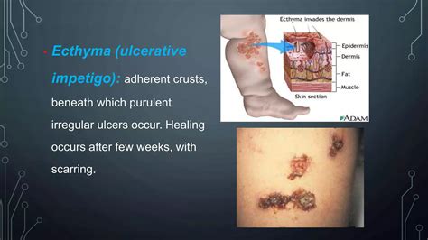 Bacterial Skin Infection Dermatology Pptx