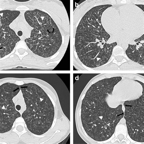 Centrilobular Nodules In High Resolution Computed Tomography Of The