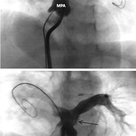 Angiogram Of The Right Ventricular Outflow Tract In Lao Cranial View