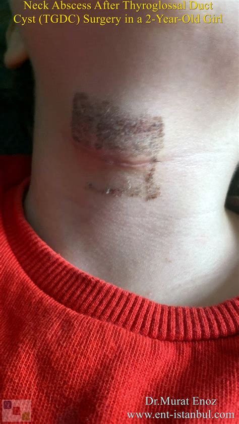 Neck Abscess After Thyroglossal Duct Cyst Tgdc Surgery In A 2 Year
