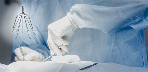 Top Rated Ivc Filter Lawsuit Lawyers Mckay Law