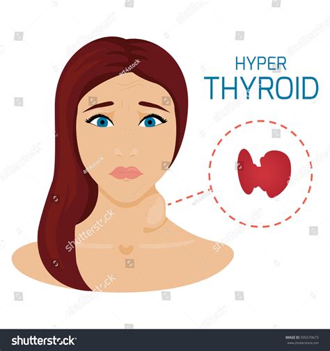 Woman Hyperthyroid Gland Hyperthyroidism Symbol Enlarged ภาพประกอบ