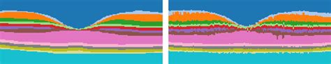 Left Initial Automatic Segmentation Of Individual B Scan Based On