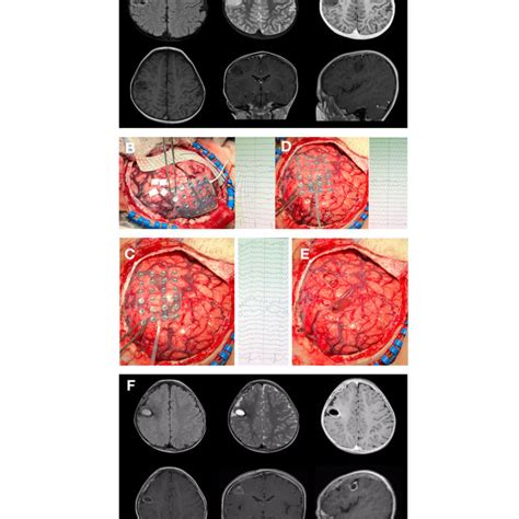 Pdf Awake Craniotomy And Brain Mapping For Brain Tumor Resection In Pediatric Patients