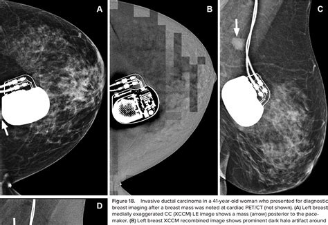 Figure 18 From False Positive And False Negative Contrast Enhanced