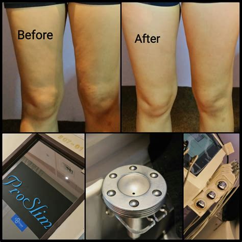Bye Celluliteorange Skin With Before And After Pictures