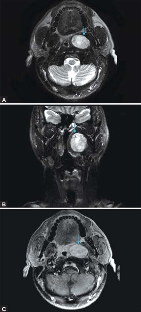 Figure 4 From Imaging Of Parapharyngeal Space And Infratemporal Fossa