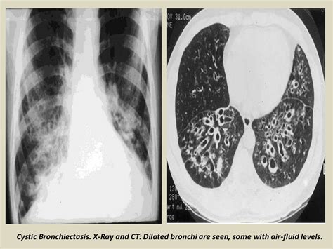 Presentation1 Pptx Radiological Imaging Of Bronchiectasis