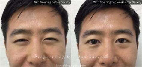 NYC Daxxify Before And After Ron Shelton M D Patient Photos