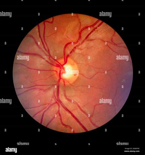 Fundus Camera Image Of The Retina Of A Normal Eye Showing The