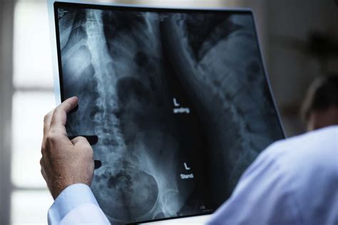 Rak Jelita Grubego Objawy I Badania Diagnostyczne Zwrotnik Raka