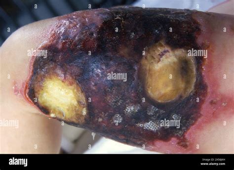 Leg Ulcers Caused By Pyoderma Gangrenosum A Rare Skin Condition This Patient Has Had Dead