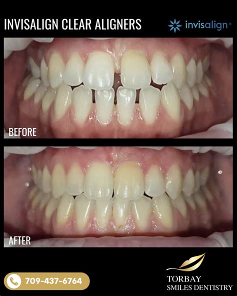 Torbay Before And After With Invisalign Clear Aligners Check Out