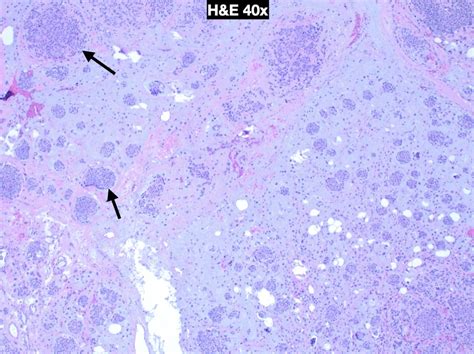 Chondroid Syringoma Of The Foot Eurorad
