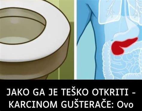 JAKO GA JE TEŠKO OTKRITI KARCINOM GUŠTERAČE Ovo je simptoma koje ne smijete ignorisati
