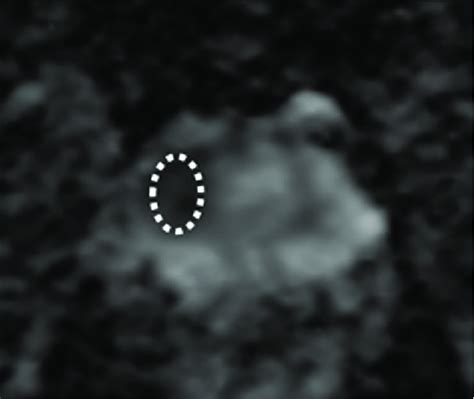 Adc Value Measurement A Representative Case Of A 71 Year Old Man With