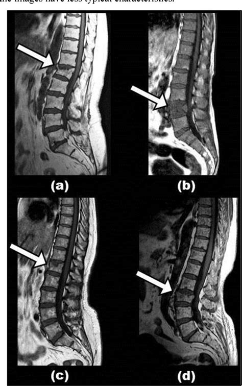 Figure 1 From Classification Of Vertebral Compression Fractures In Magnetic Resonance Images
