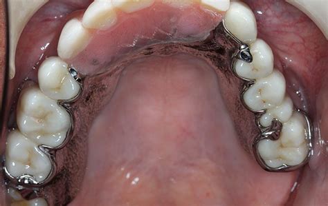 Both Jaws Implant Over Partials Male Dental Implant Center