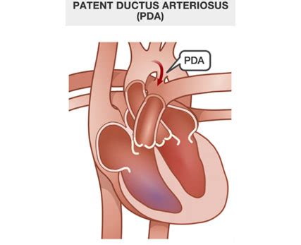 PDA Device Closure Dr N Srinath Reddy Pediatric Cardiologist