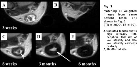 Figure 2 From Magnetic Resonance Imaging Of Achilles Tendon Normal