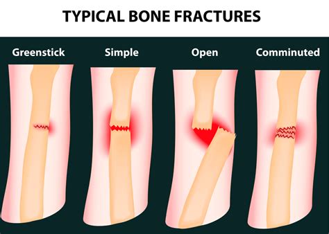 How Does A Spiral Fracture Heal At Jordan Arcelia Blog