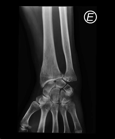 Pre Operative X Ray Posteroanterior View Download Scientific Diagram