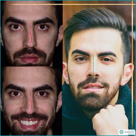 دکتر روزینا بشارتی زاده جراح بینی تهران؛ هزینه نمونه کار