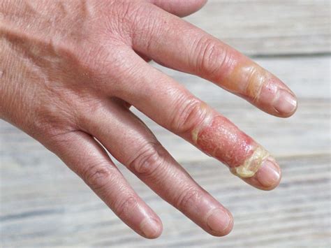 Vỡ Vết Bỏng Áp Dụng Ngay Mẹo Chữa Vết Bỏng Bị Vỡ Nước