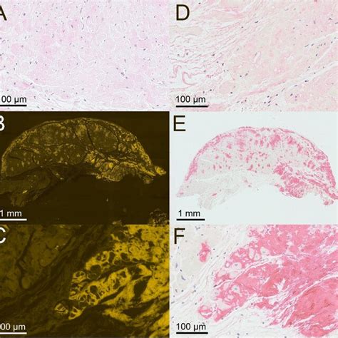 Results Of The Myocardial Biopsy Hematoxylin And Eosin Stain Panel A