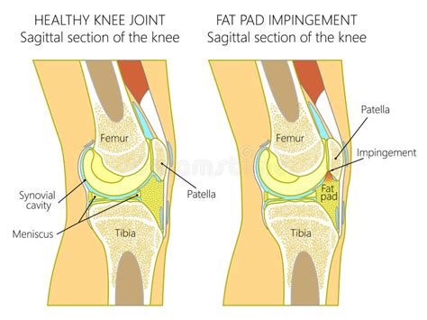 Anatomy Of The Kneefat Pad Impingement Due To Hyperextension Stock